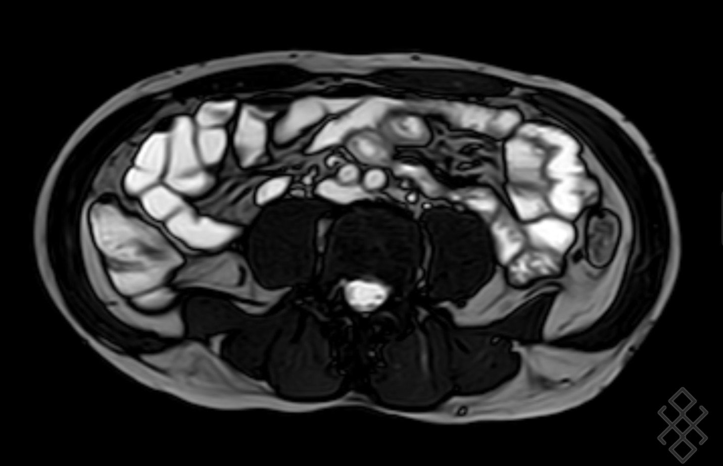 Entéro-IRM - Définition & Déroulement - Prise de rdv en ligne