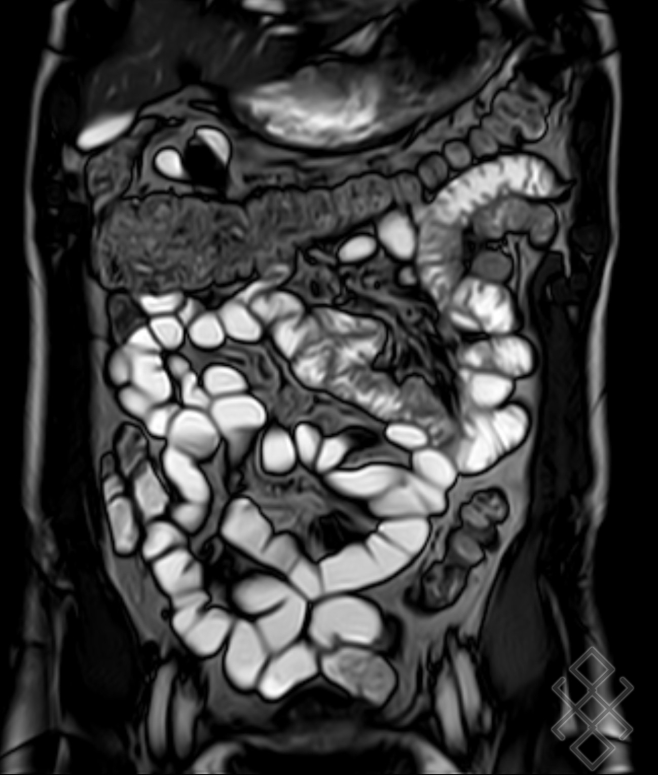 Entéro-IRM - Définition & Déroulement - Prise de rdv en ligne