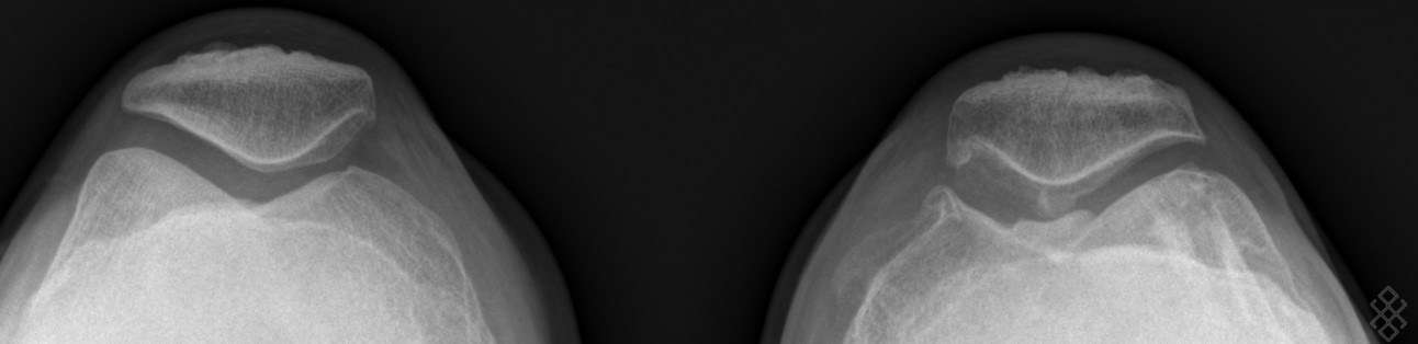 Radiographie du Genou - Définition & Déroulement - Prise de rdv en ligne