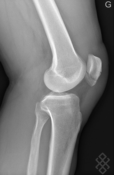 Radiographie du Genou - Définition & Déroulement - Prise de rdv en ligne