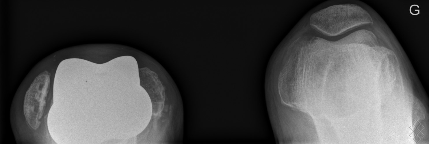 Radiographie du Genou - Définition & Déroulement - Prise de rdv en ligne