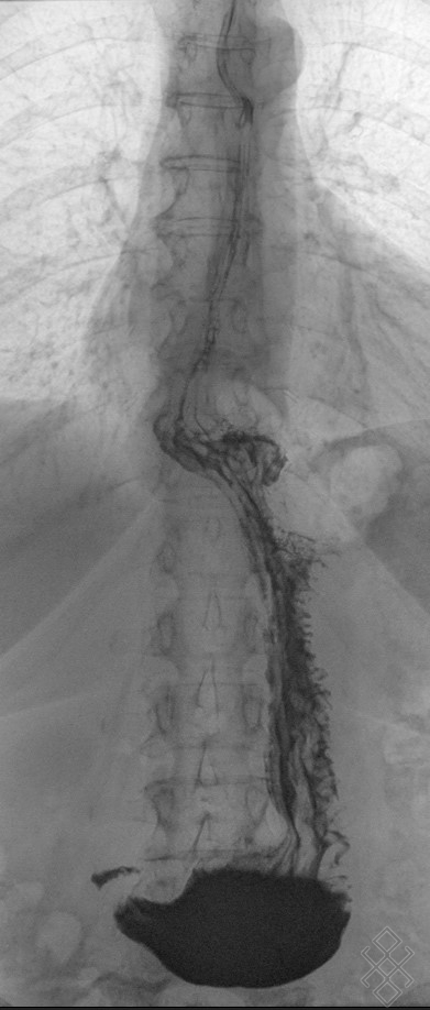 Transit Oeso-Gastro-Duodénal (TOGD) - Définition & Déroulement - Prise ...