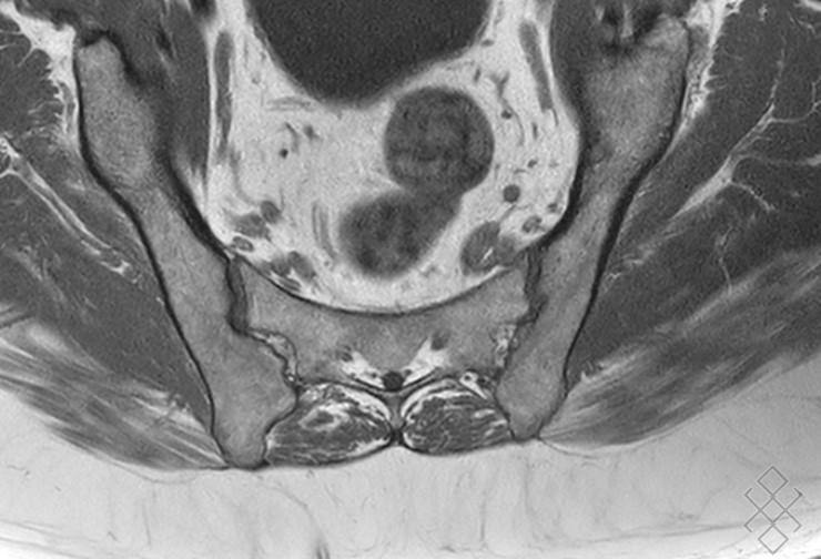 IRM des Sacro-iliaques - Définition & Déroulement - Prise de rdv 100% ...