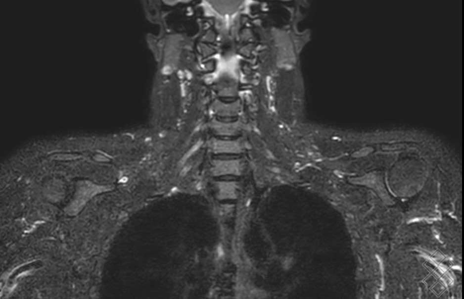 IRM du Rachis cervical - Définition & Déroulement - Prise de rdv en ligne