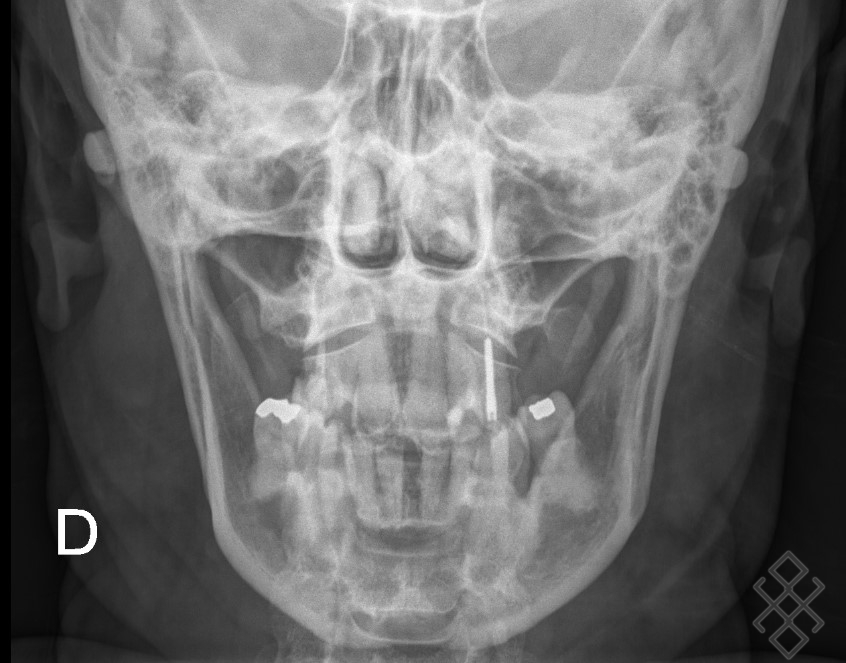 Radiographie des Articulations Temporo Mandibulaires (ATM) - Définition ...