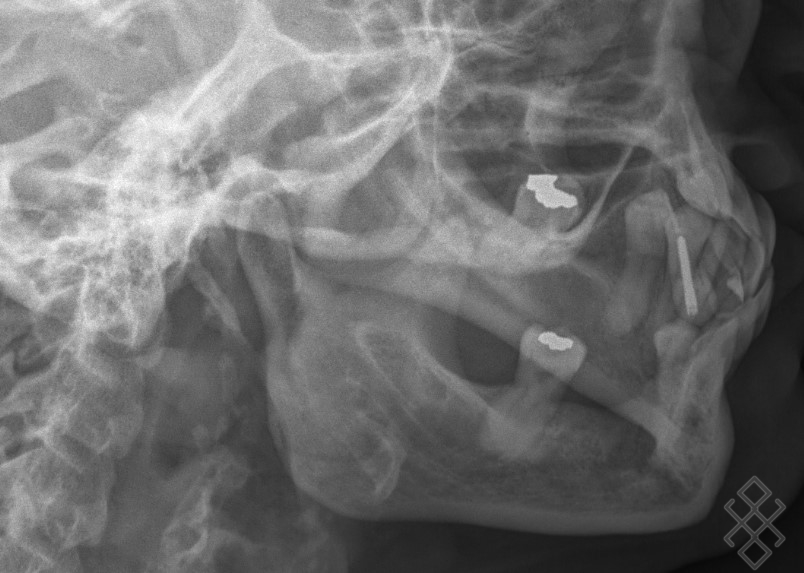Radiographie des Articulations Temporo Mandibulaires (ATM) - Définition ...