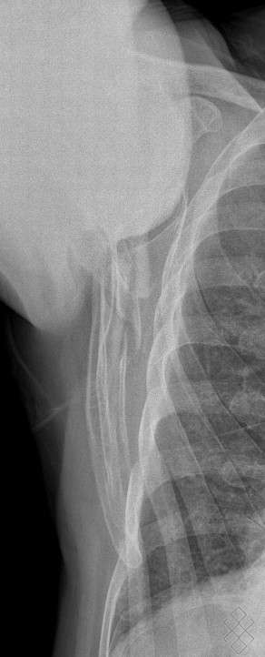 Radiographie de l’Omoplate - Définition & Déroulement - Prise de rdv ...