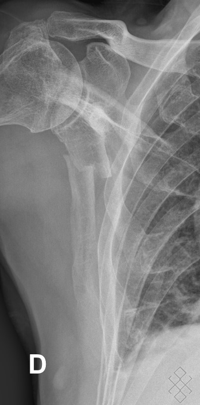 Radiographie de l’Omoplate - Définition & Déroulement - Prise de rdv ...