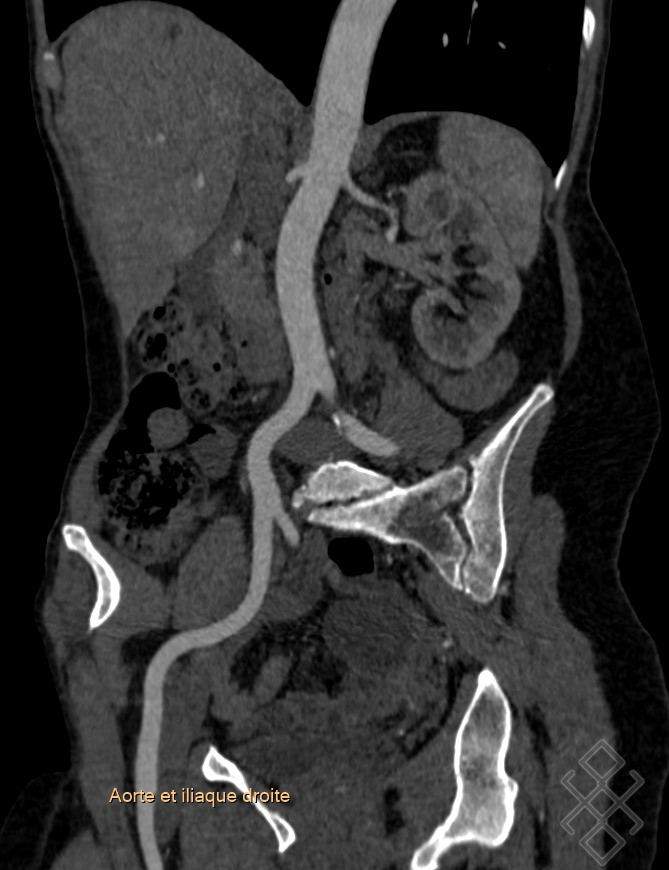 Angioscanner Abdominal - Définition & Déroulement - Prise de rdv en ligne
