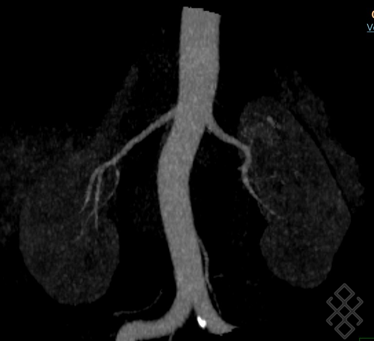 Angioscanner Abdominal - Définition & Déroulement - Prise de rdv en ligne