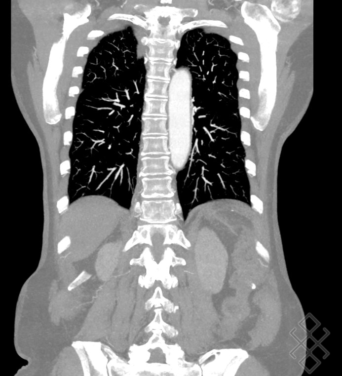 Angioscanner Thoracique - Définition & Déroulement - Prise de rdv 100% ...