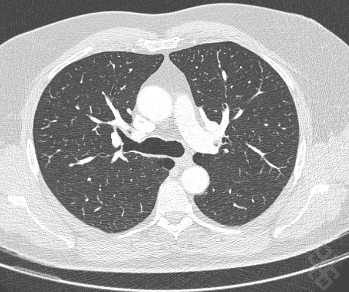 Angioscanner Thoracique - Définition & Déroulement - Prise de rdv 100% ...