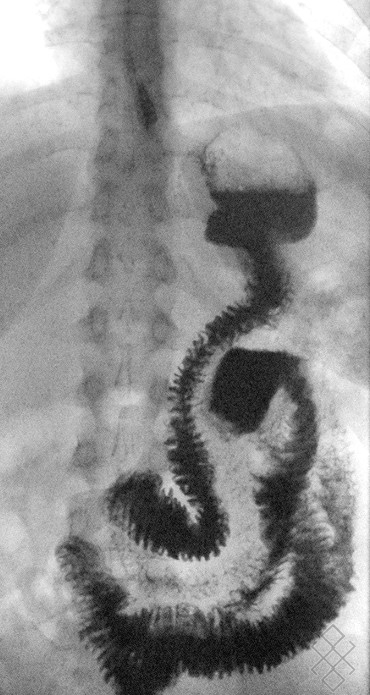 Transit du Grêle (Entéroclyse) - Définition & Déroulement - Prise de ...