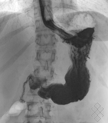 Transit Oeso-Gastro-Duodénal (TOGD) - Définition & Déroulement - Prise ...