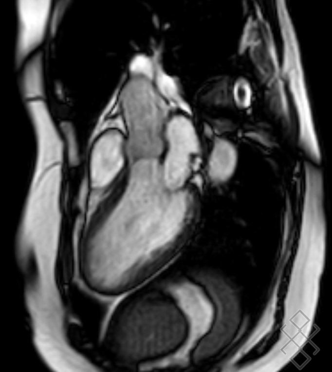 IRM Cardiaque morphologique - Définition & Déroulement - Prise de rdv en ligne