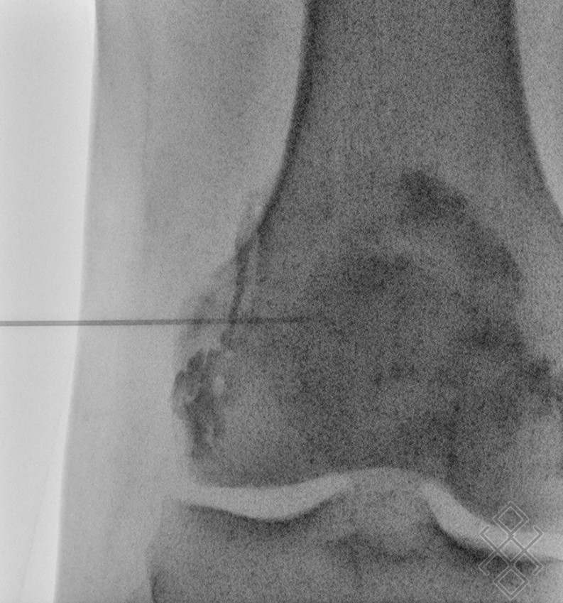 Infiltration du Genou - Définition & Déroulement - Prise de rdv en ligne