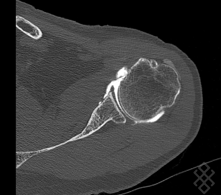 Arthroscanner de l’Épaule - Définition & Déroulement - Prise de rdv en ...