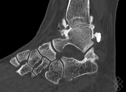 Arthroscanner de la Cheville - Définition & Déroulement - Prise de rdv ...