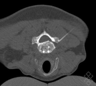 Infiltration Cervicale sous Scanner - Définition & Déroulement - Prise ...