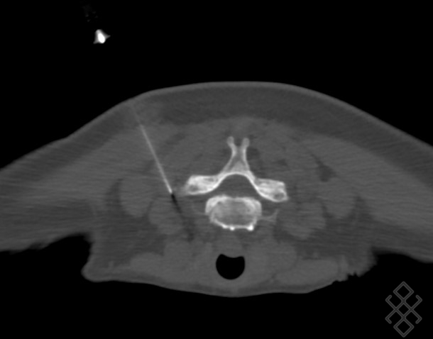 Infiltration Cervicale sous Scanner - Définition & Déroulement - Prise ...