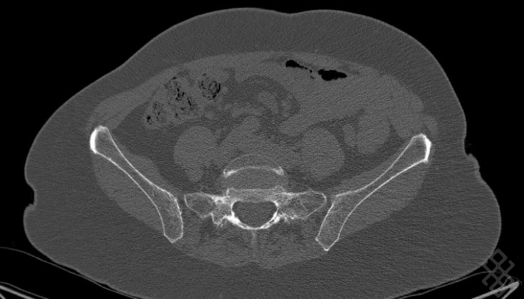 Scanner du Bassin - Définition & Déroulement - Prise de rdv en ligne