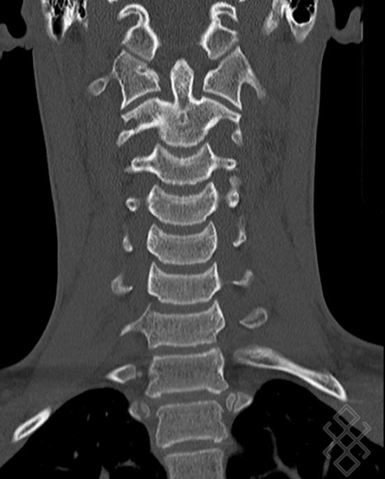 Scanner du Rachis cervical - Définition & Déroulement - Prise de rdv ...