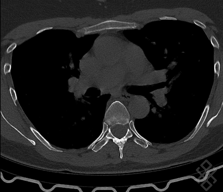 Scanner du Rachis dorsal - Définition & Déroulement - Prise de rdv en ligne
