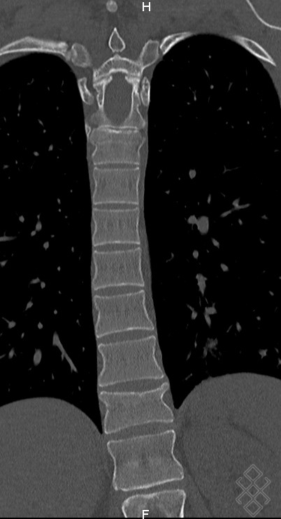 Scanner du Rachis dorsal - Définition & Déroulement - Prise de rdv en ligne