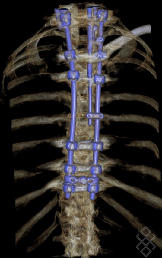 Scanner du Rachis dorsal - Définition & Déroulement - Prise de rdv en ligne