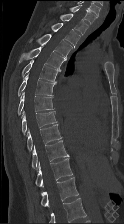 Scanner du Rachis dorsal - Définition & Déroulement - Prise de rdv en ligne