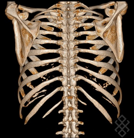 Scanner du Rachis dorsal - Définition & Déroulement - Prise de rdv en ligne