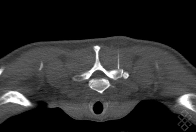 Infiltration Cervicale sous Scanner - Définition & Déroulement - Prise ...