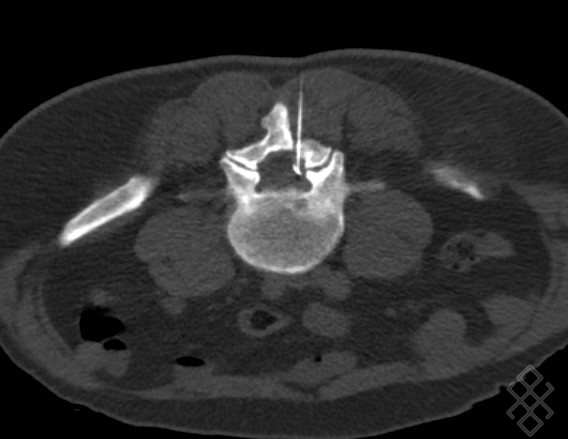 Infiltration Lombaire sous Scanner - Définition & Déroulement - Prise ...