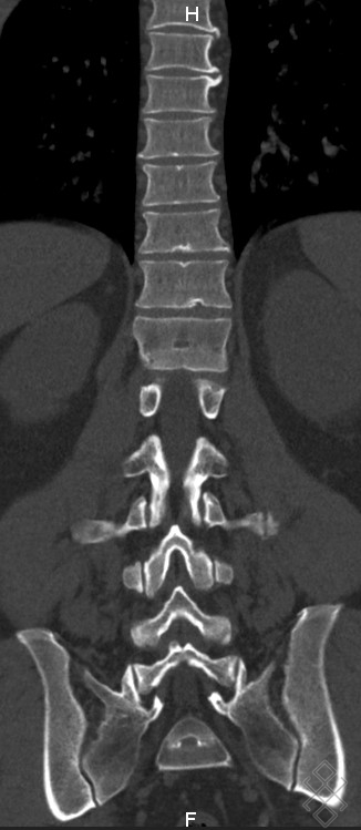 Scanner du Rachis dorsal - Définition & Déroulement - Prise de rdv en ligne