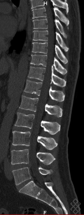Scanner du Rachis dorsal - Définition & Déroulement - Prise de rdv en ligne