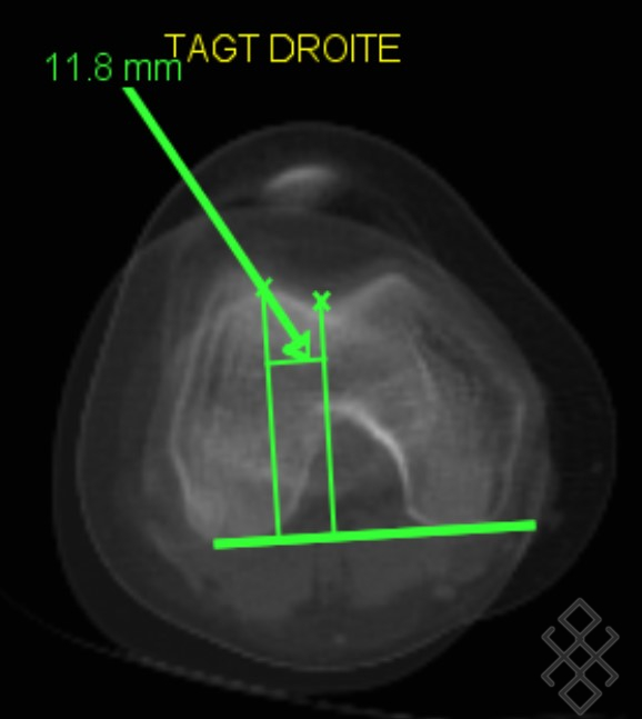 Scanner du Genou - Définition & Déroulement - Prise de rdv en ligne