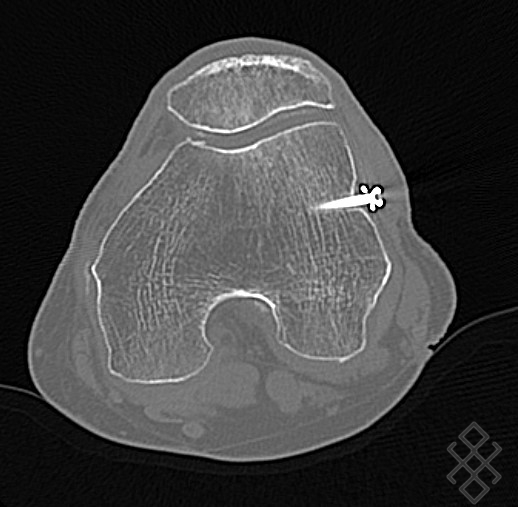 Scanner du Genou - Définition & Déroulement - Prise de rdv en ligne