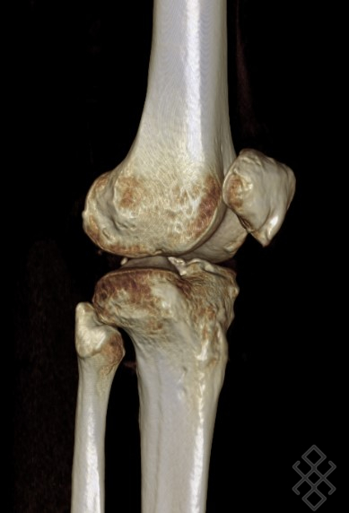 Scanner du Genou - Définition & Déroulement - Prise de rdv en ligne
