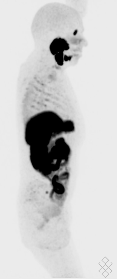 TEP-Scan au PSMA - Définition & Déroulement - Prise de rdv en ligne