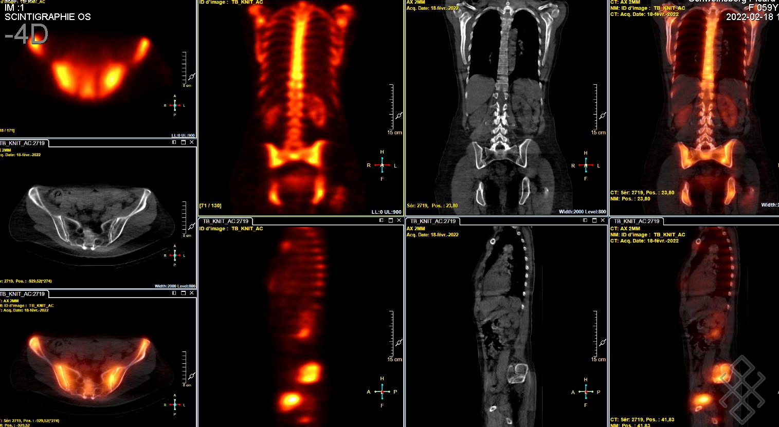 Scintigraphie Osseuse - Définition & Déroulement - Prise de rdv en ligne