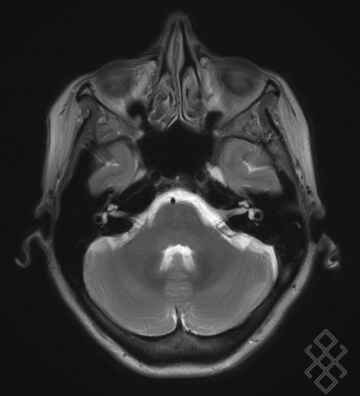 IRM des Conduits Auditifs Internes (CAI) - Définition & Déroulement ...