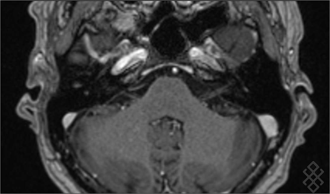 IRM des Conduits Auditifs Internes (CAI) - Définition & Déroulement ...