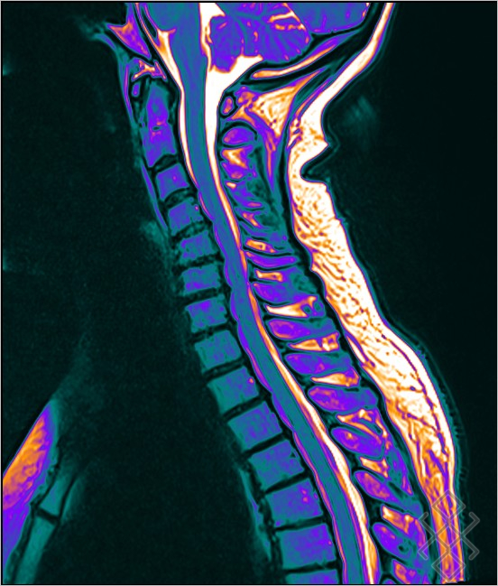 IRM du Rachis cervical - Définition & Déroulement - Prise de rdv 100% ...