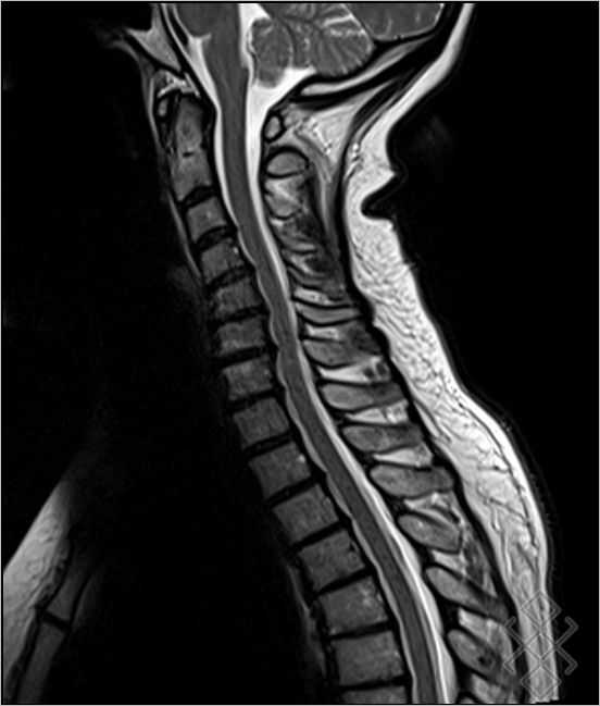 IRM du Rachis cervical - Définition & Déroulement - Prise de rdv 100% ...