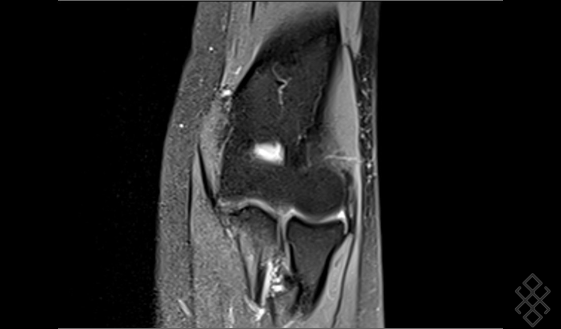 IRM du Coude - Définition & Déroulement - Prise de rdv en ligne