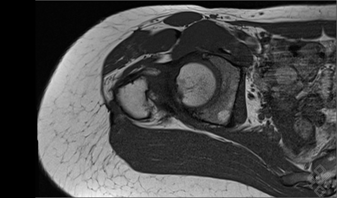 IRM de la Hanche - Définition & Déroulement - Prise de rdv en ligne
