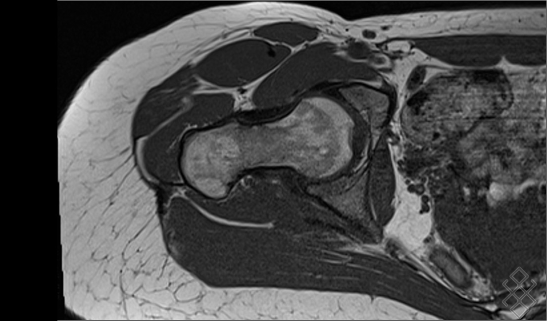 IRM de la Hanche - Définition & Déroulement - Prise de rdv en ligne