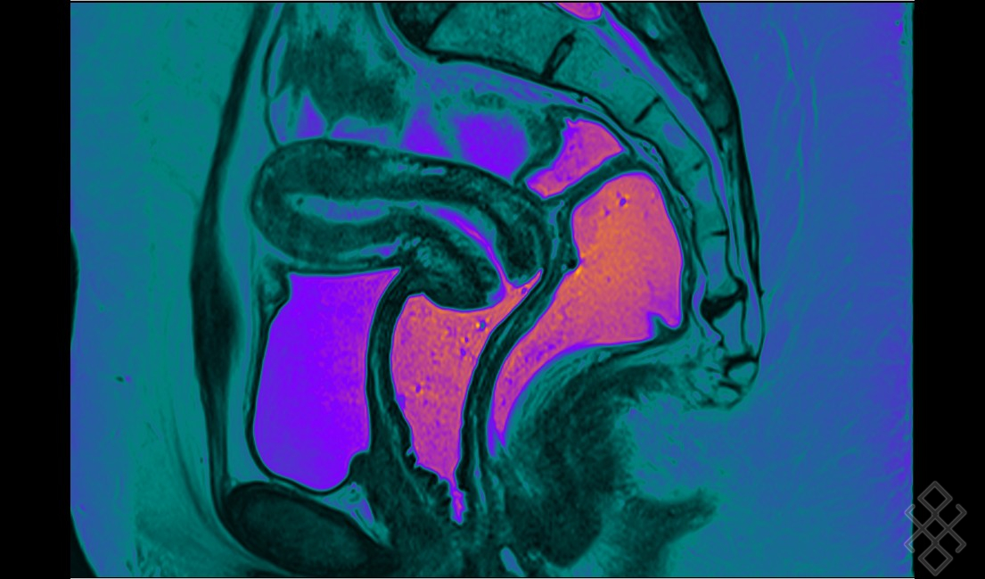 IRM Pelvienne - Définition & Déroulement - Prise de rdv en ligne