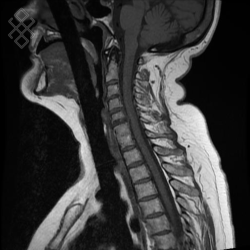 IRM du Rachis cervical - Définition & Déroulement - Prise de rdv 100% ...